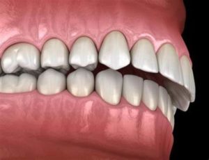 What Causes an Overbite and How to Correct it? – SDalign Invisible ...